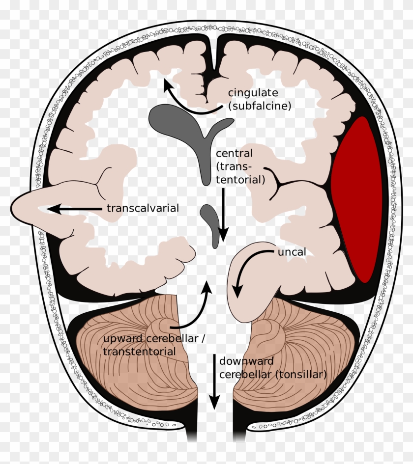 Types Of Brain Herniation[3] 1) Uncal 2) Central 3) - Brain Herniation ...